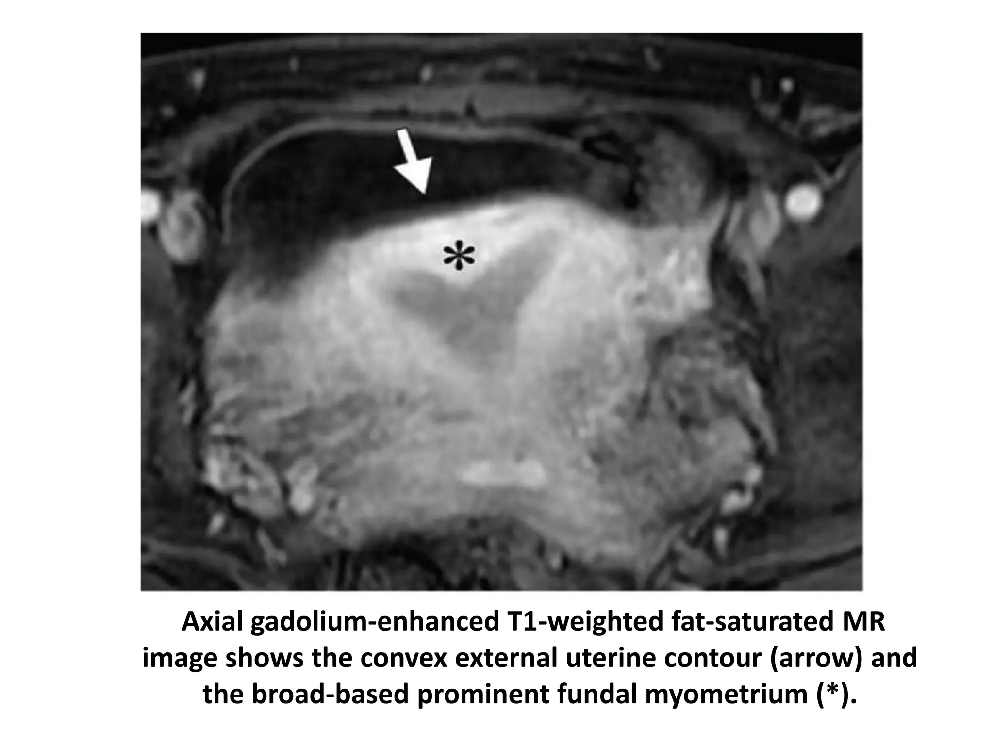 Benign pelvic diseases in females 2 | PPTX