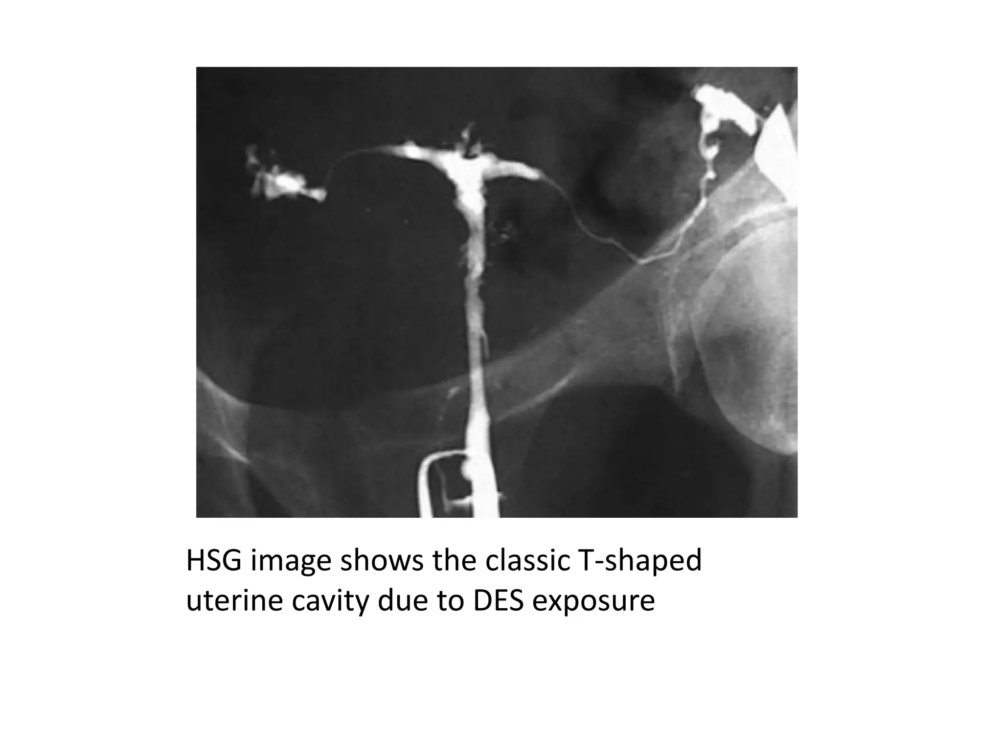 Benign pelvic diseases in females 2 | PPTX