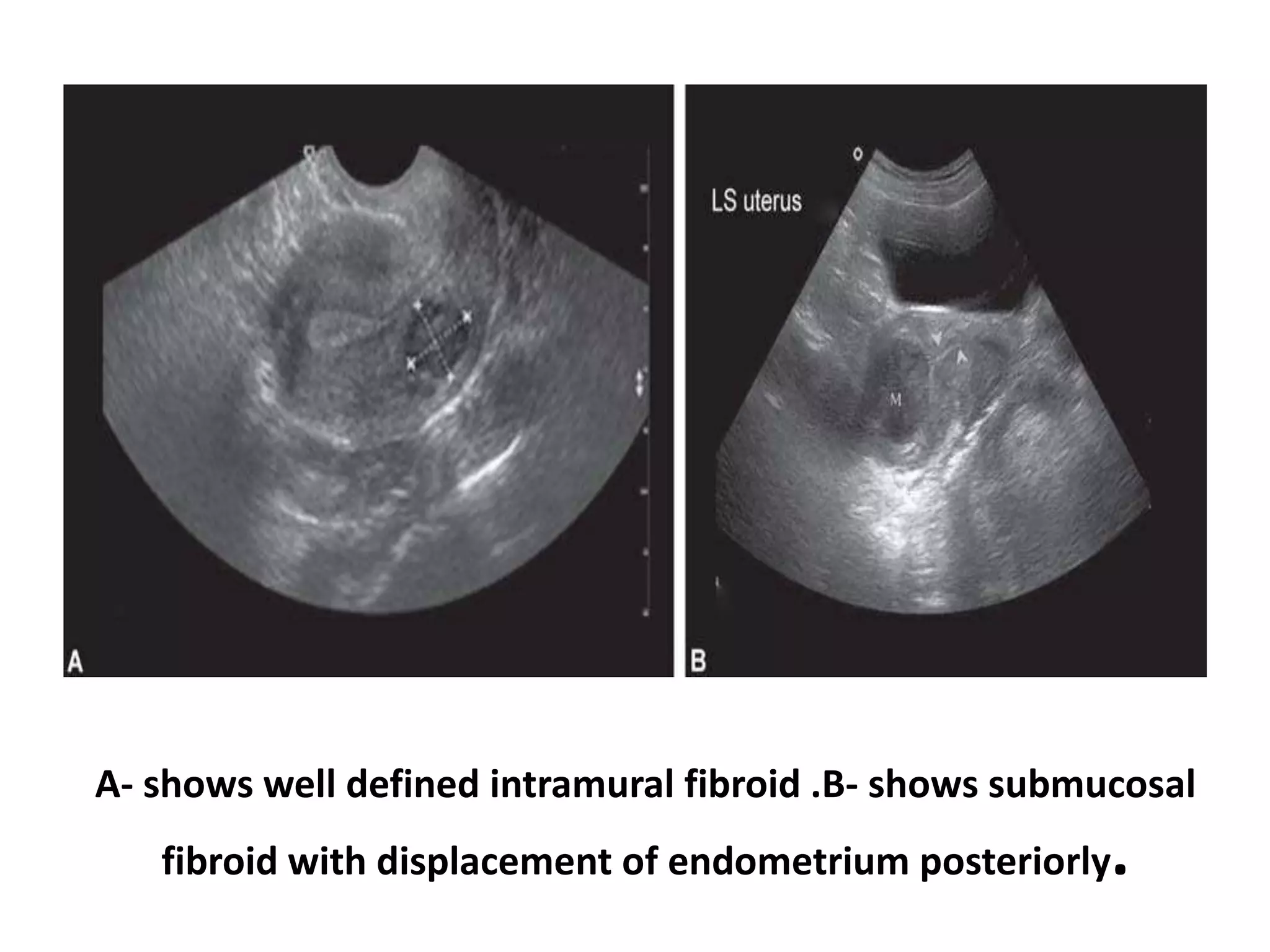 Benign pelvic diseases in females 2 | PPTX