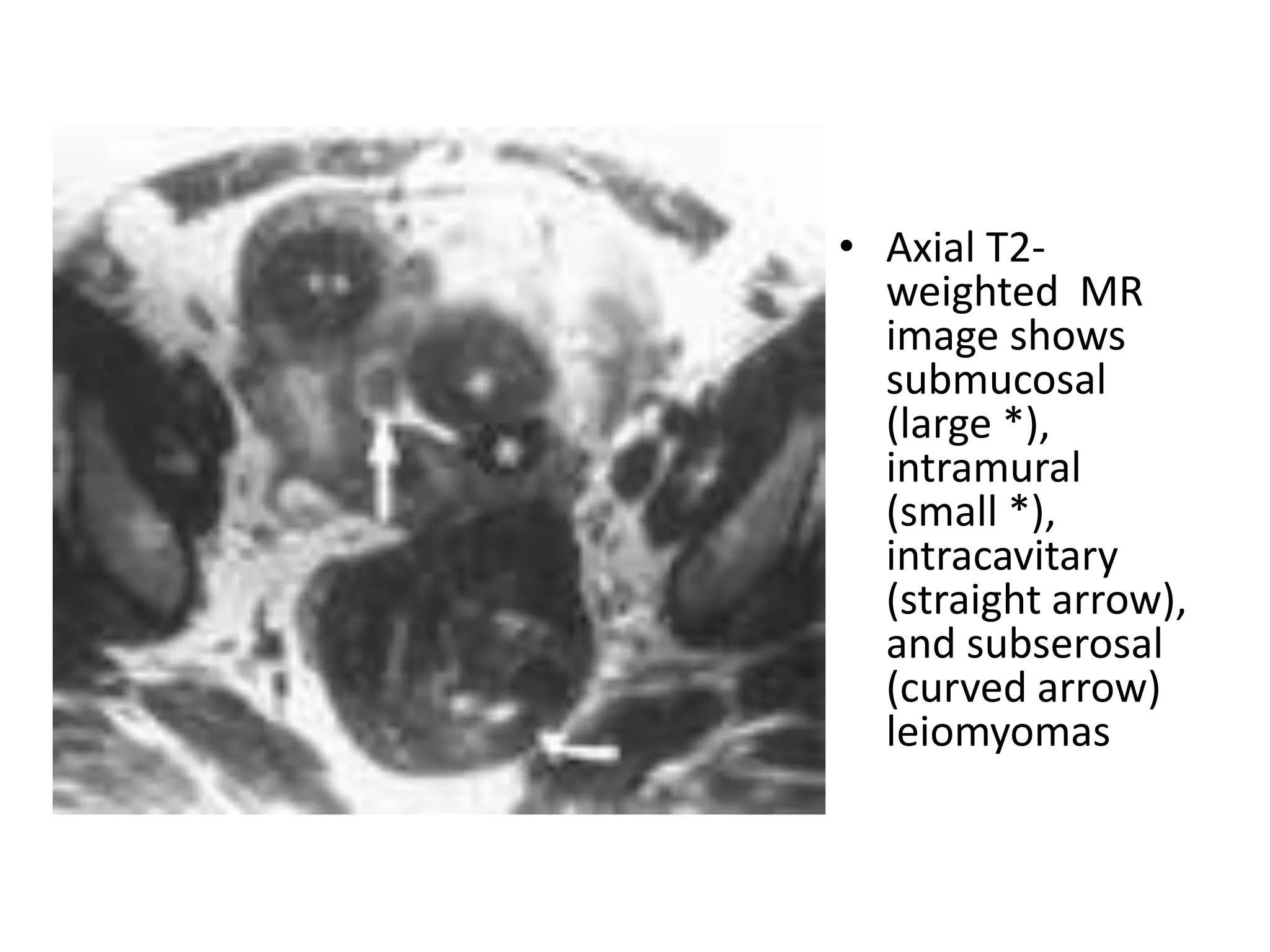 Benign pelvic diseases in females 2 | PPTX