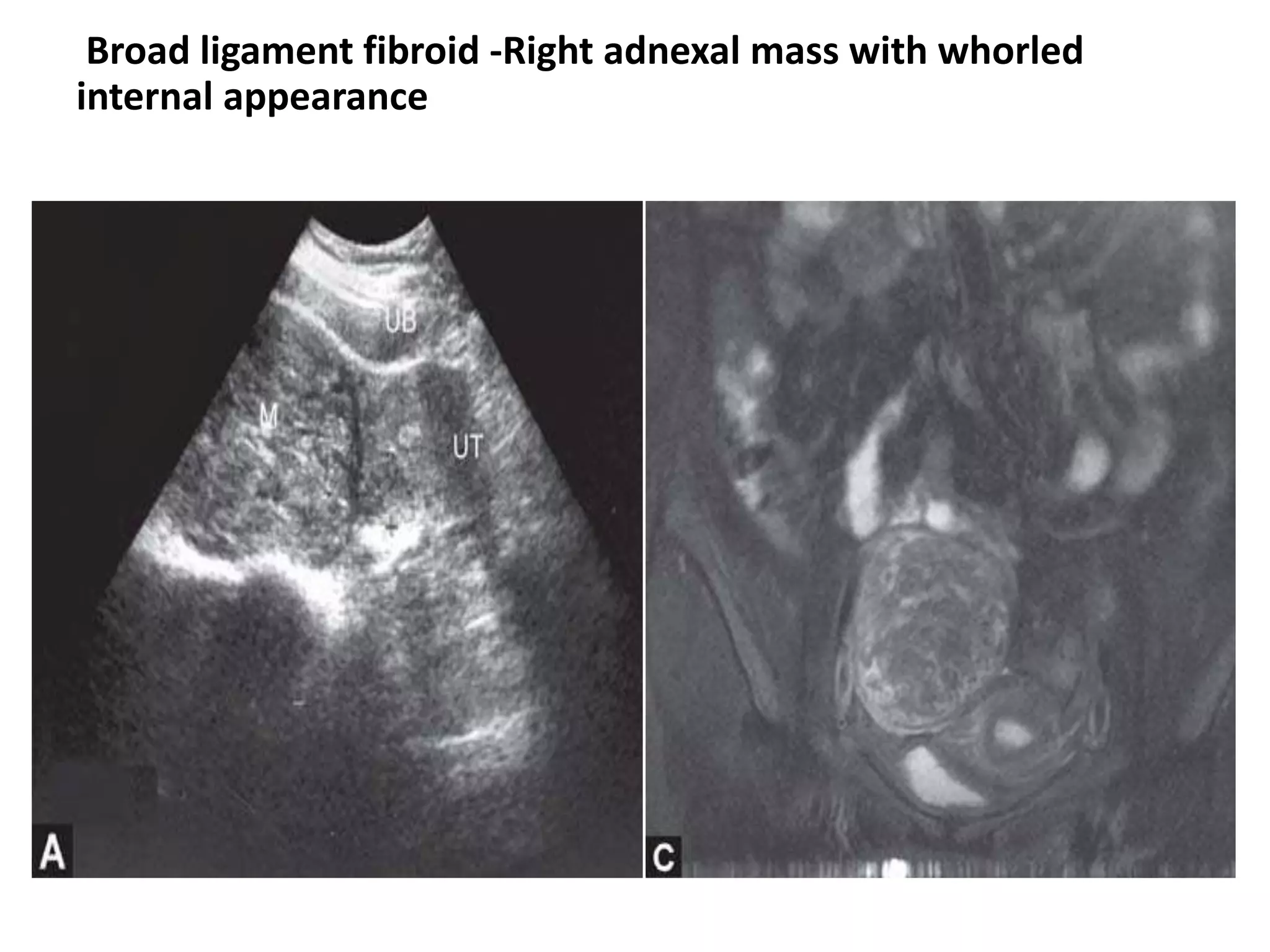 Benign pelvic diseases in females 2 | PPTX
