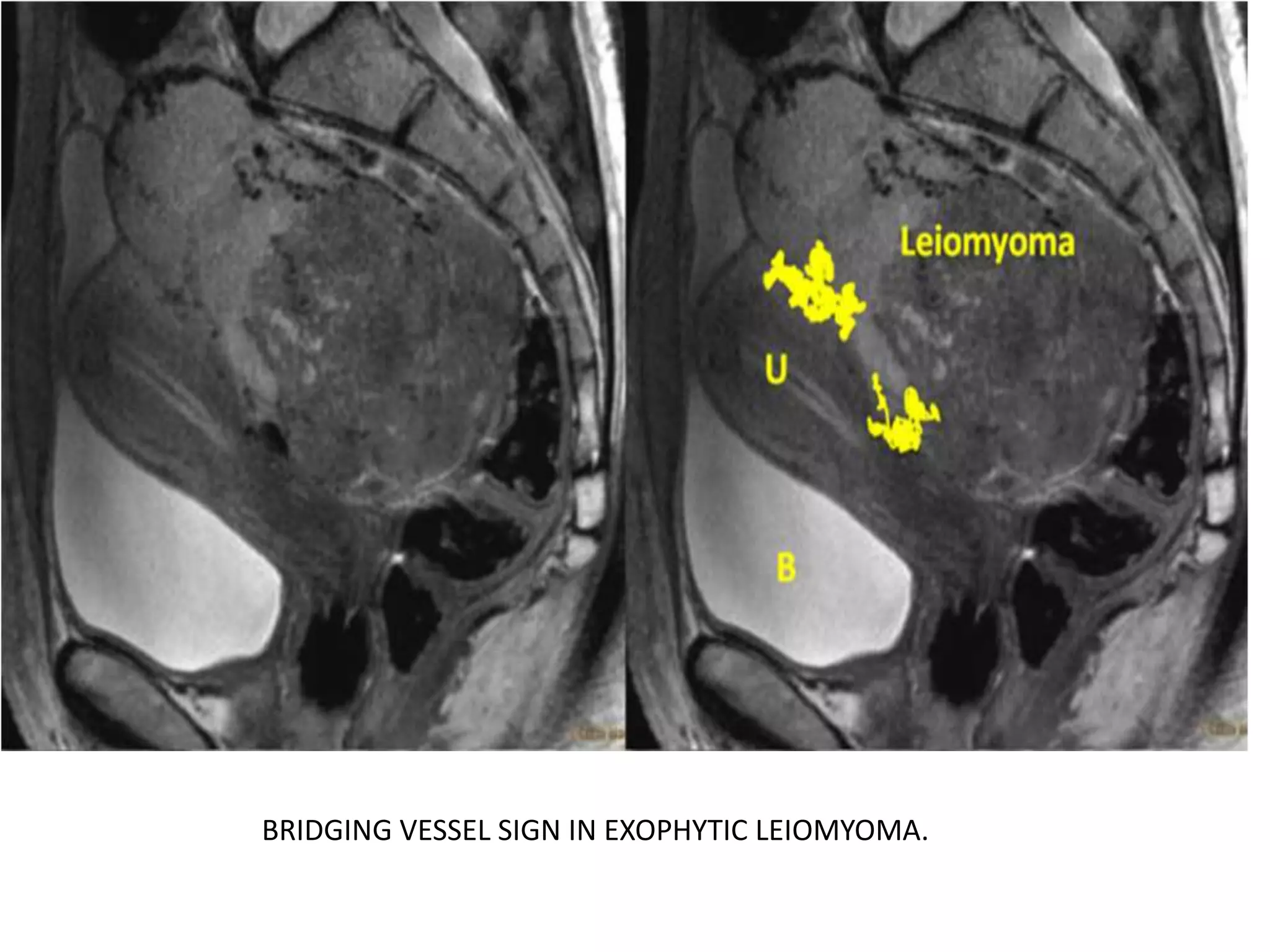Benign pelvic diseases in females 2 | PPTX