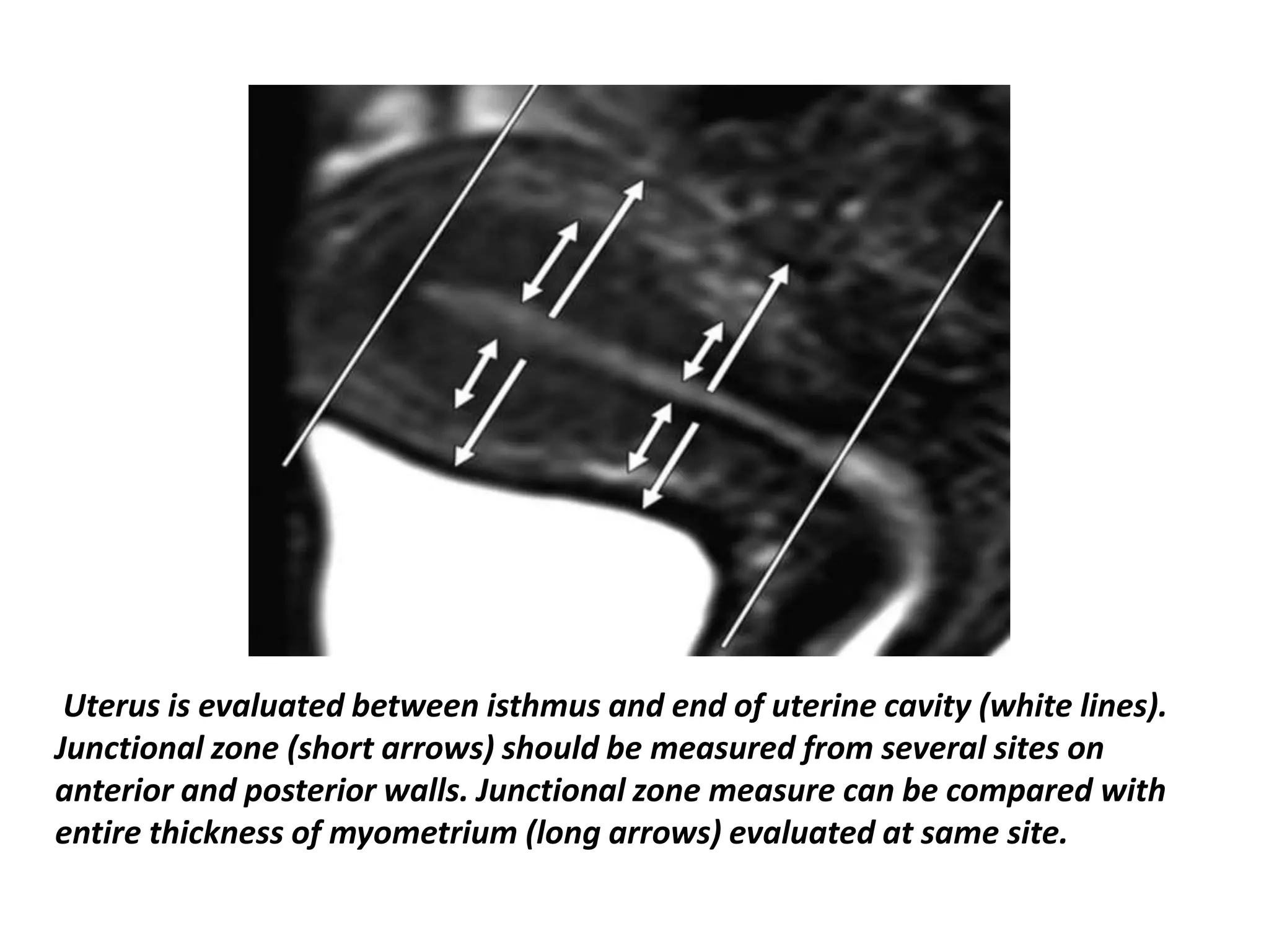 Benign pelvic diseases in females 2 | PPTX