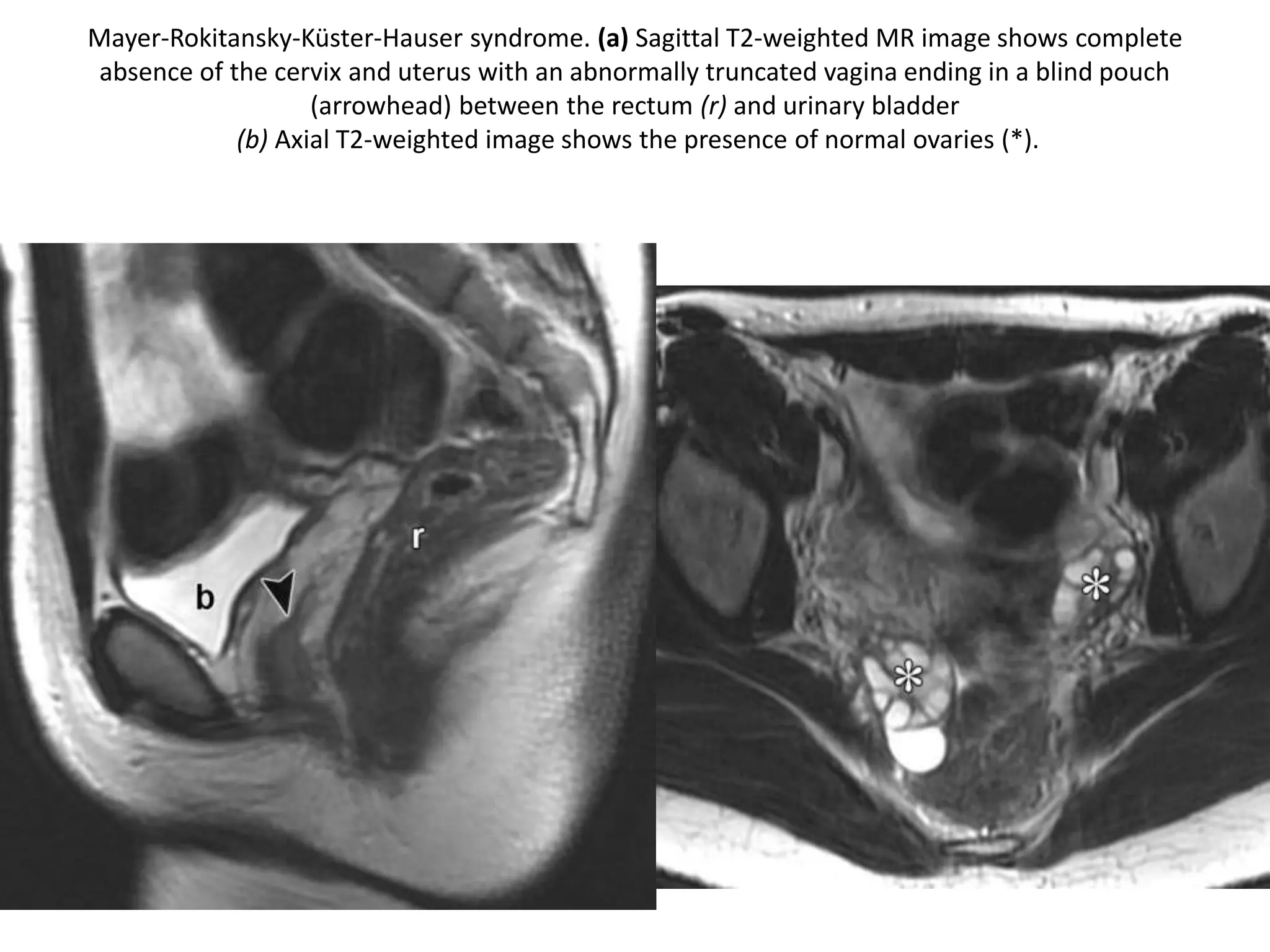 Benign pelvic diseases in females 2 | PPTX