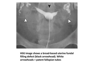 Benign pelvic diseases in females 2 | PPTX