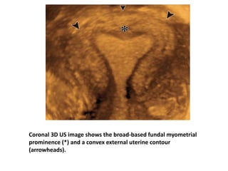 Benign pelvic diseases in females 2 | PPTX