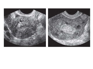 Benign pelvic diseases in females 2 | PPTX