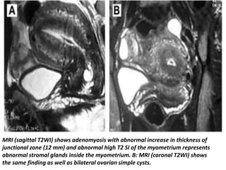 Benign pelvic diseases in females 2 | PPTX