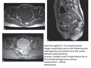 Benign pelvic diseases in females 2 | PPTX