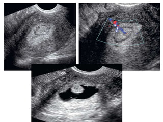 Benign pelvic diseases in females 2 | PPTX