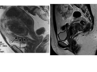 Benign pelvic diseases in females 2 | PPTX