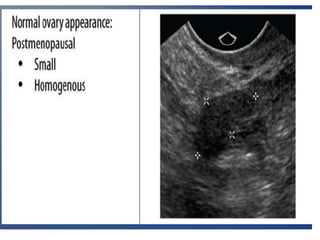 Benign pelvic diseases in females 2 | PPTX