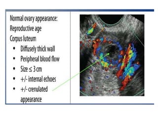 Benign pelvic diseases in females 2 | PPTX