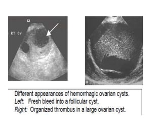 Benign pelvic diseases in females 2 | PPTX