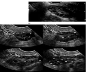 Benign pelvic diseases in females 2 | PPTX