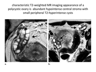 Benign pelvic diseases in females 2 | PPTX