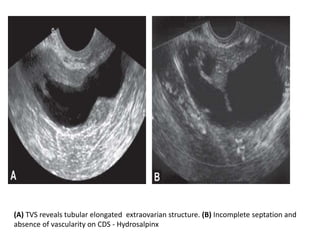 Benign pelvic diseases in females 2 | PPTX