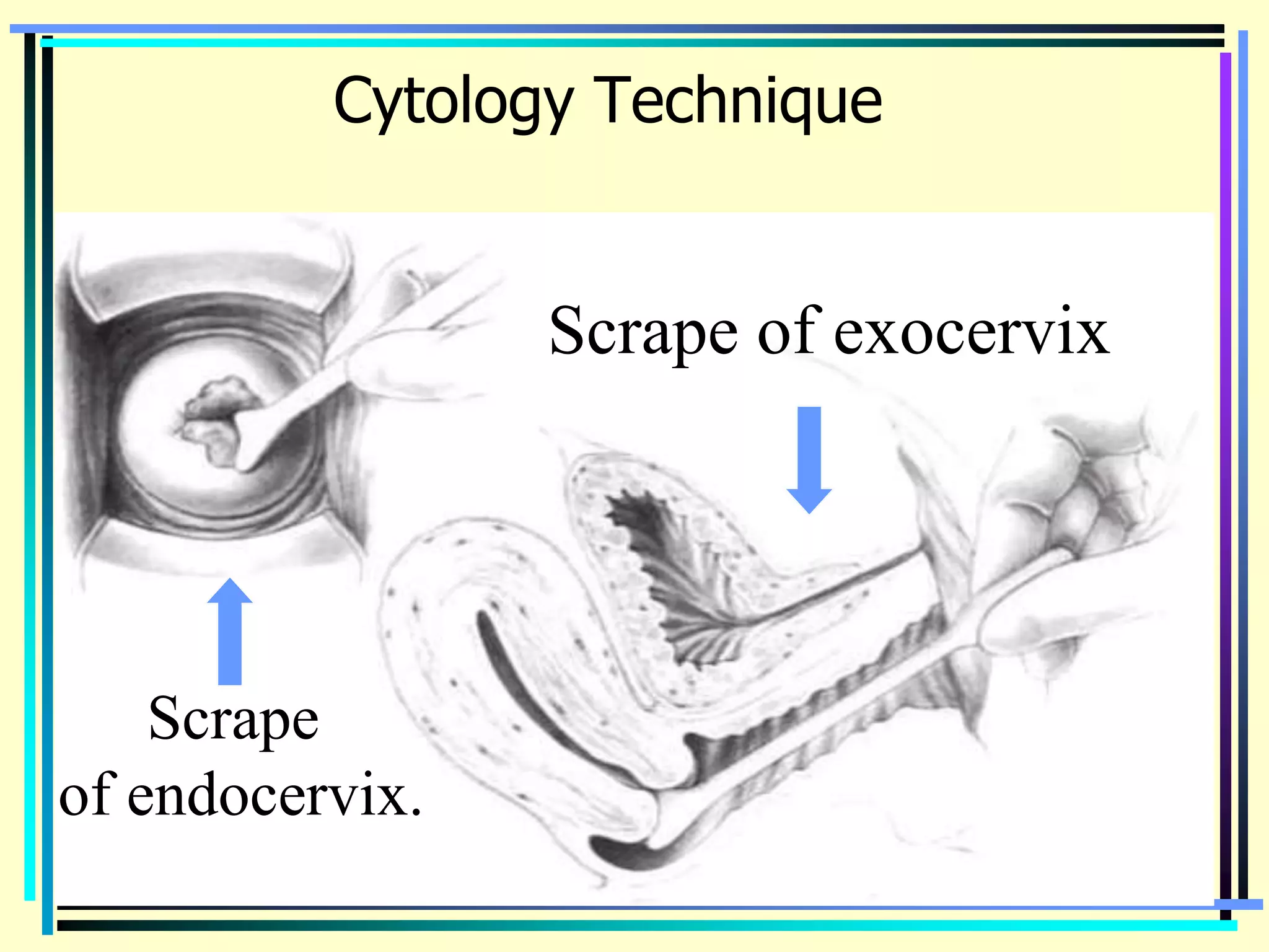 Benign & precancerous tumors of female genital organs | PPTX