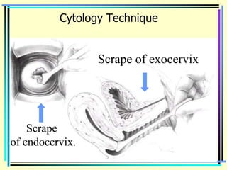 Benign & precancerous tumors of female genital organs | PPTX