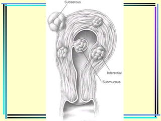 Benign & precancerous tumors of female genital organs | PPTX