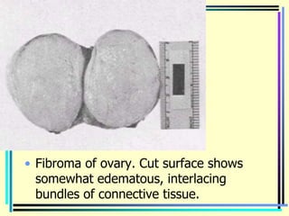 Benign & precancerous tumors of female genital organs | PPTX