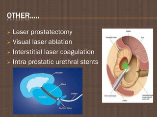 Benign Prostate Hypertrophy for nursing students | PPTX