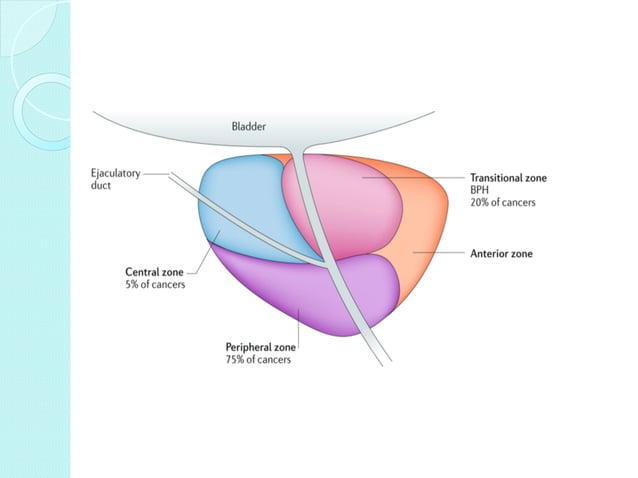 BENIGN PROSTATE HYPERTROPHY.pdf