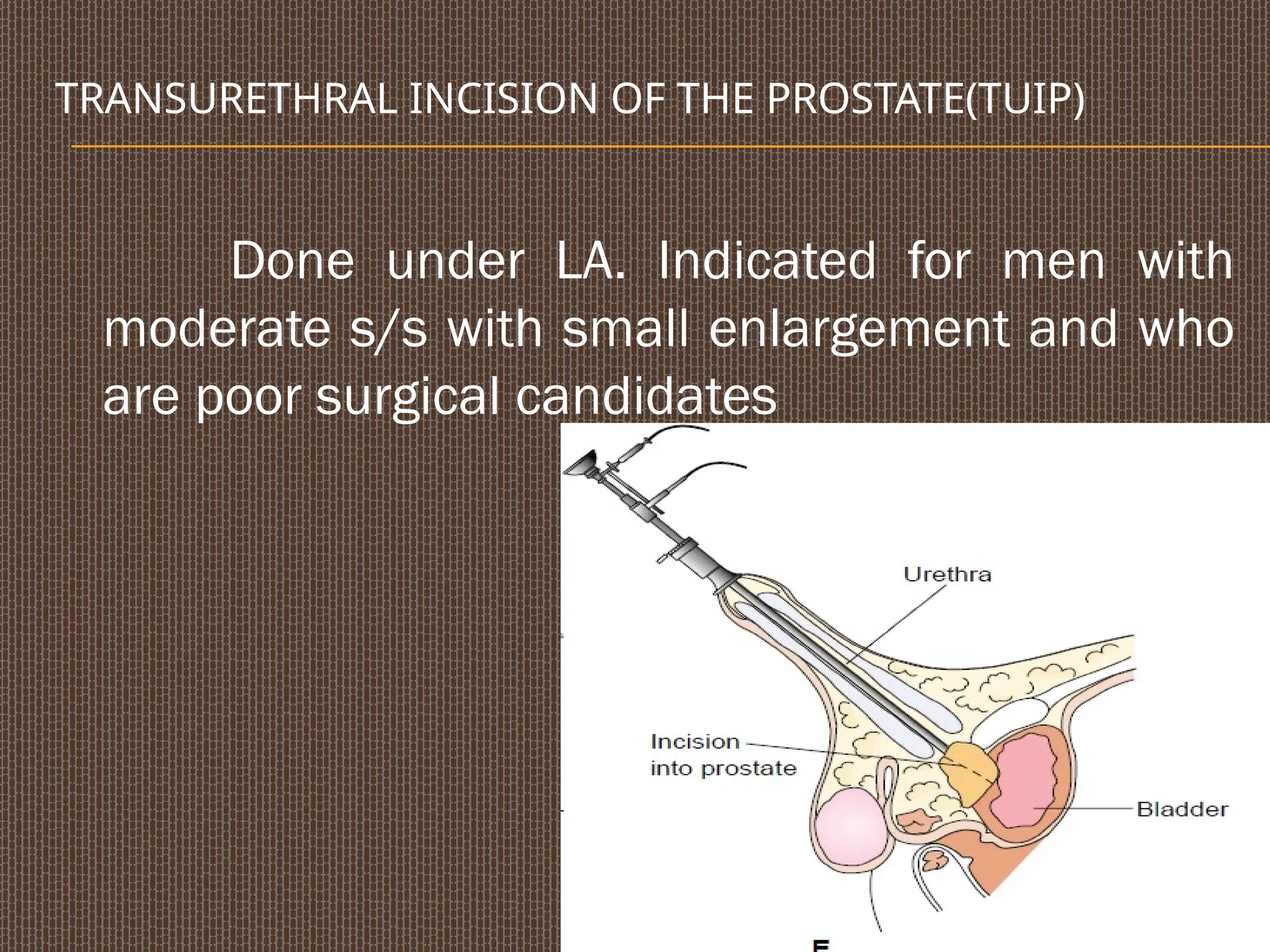 benign prostate hypertrophy.pptxlllllll,m | PPTX