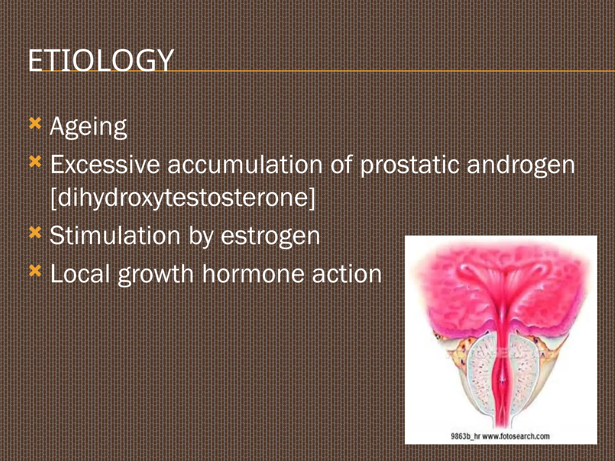 benign prostate hypertrophy.pptxlllllll,m | PPTX