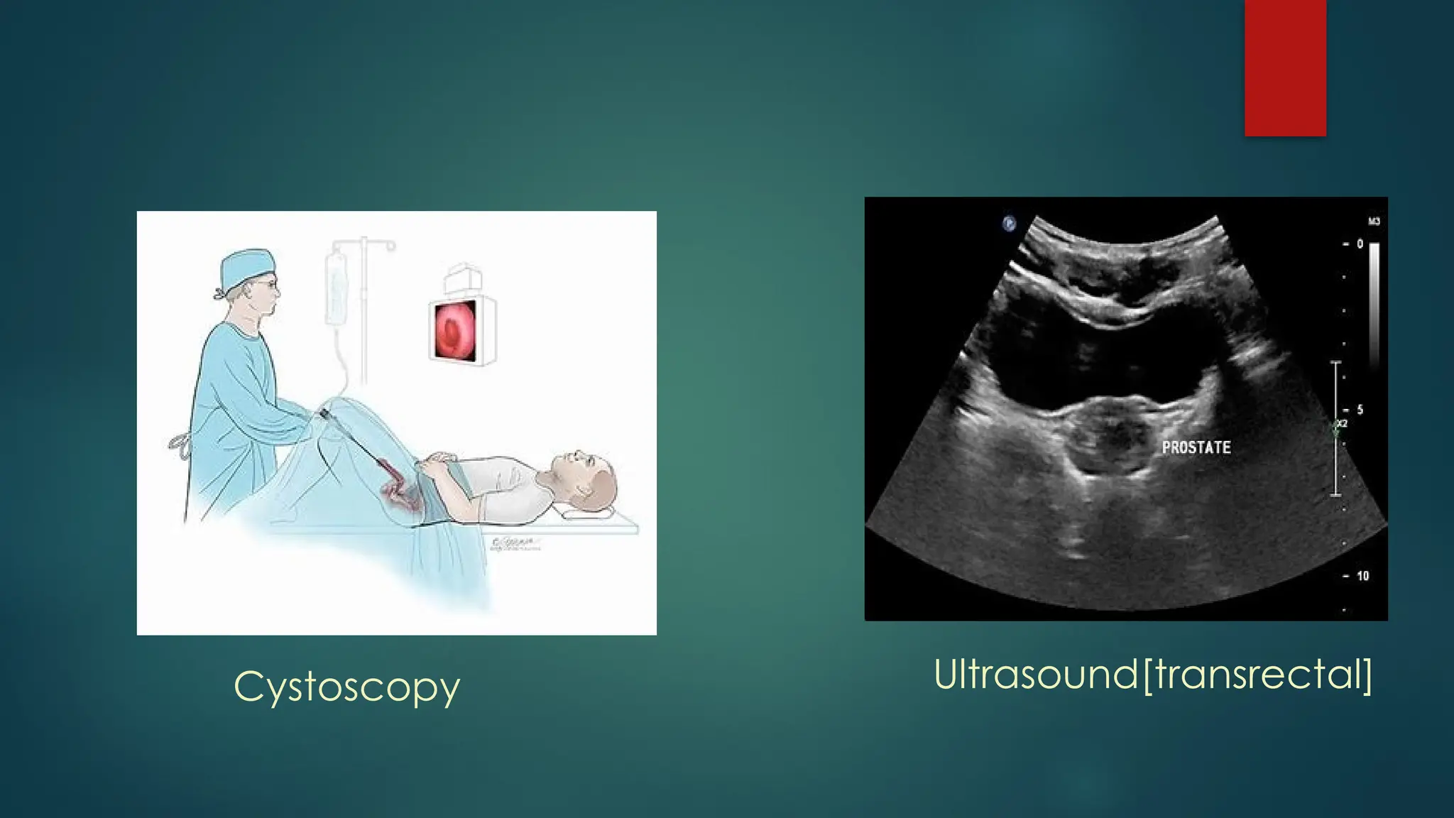 Benign prostate hypertrophy.pptx . | PPTX