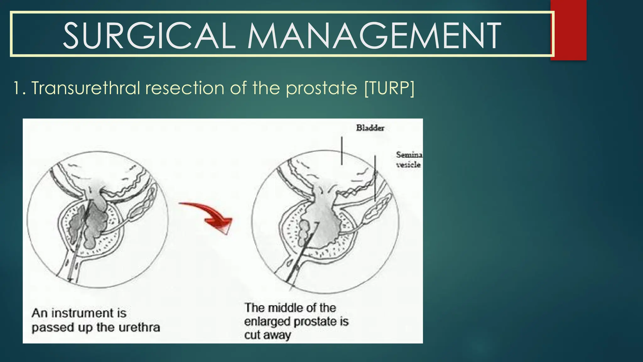 Benign prostate hypertrophy.pptx . | PPTX