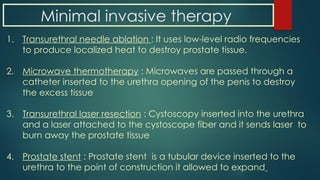 Benign prostate hypertrophy.pptx . | PPTX
