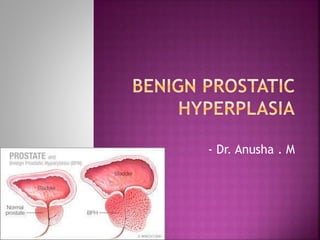 Benign prostatic hyperplasia | PPT