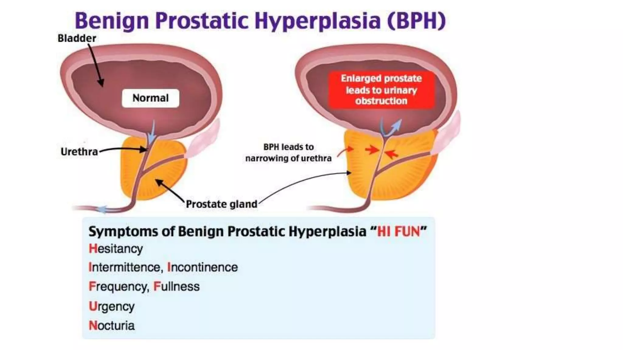 Benign Prostatic Hyperplasia-1.pptx