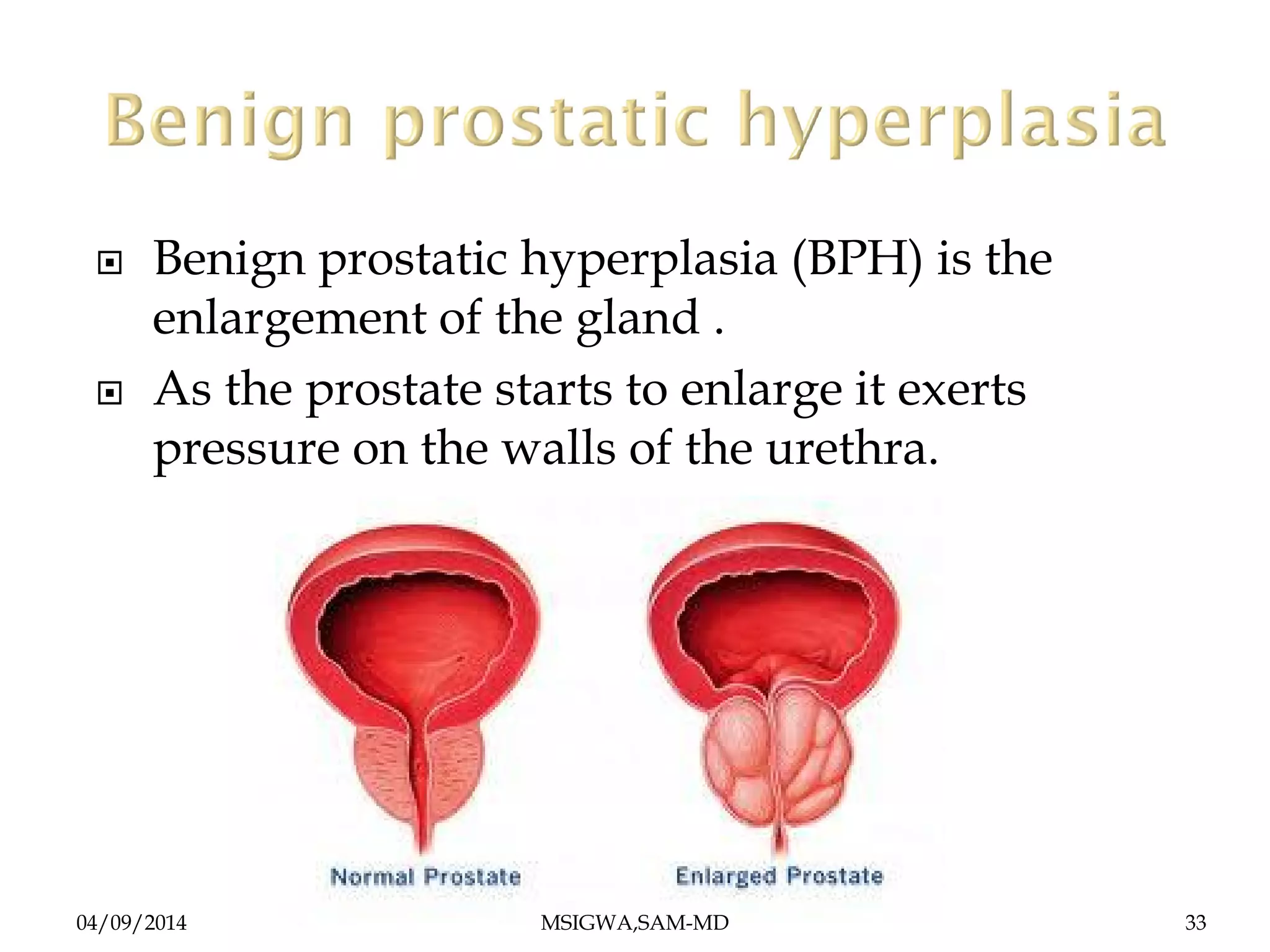 Benign prostatic hyperplasia | PPT