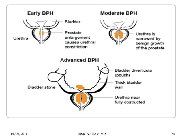 Benign prostatic hyperplasia | PDF