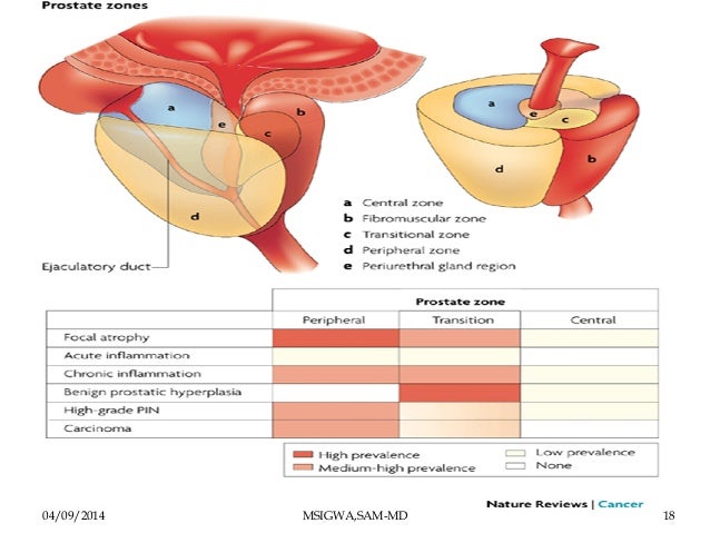 Benign prostatic hyperplasia
