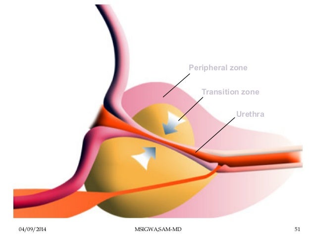 Benign prostatic hyperplasia