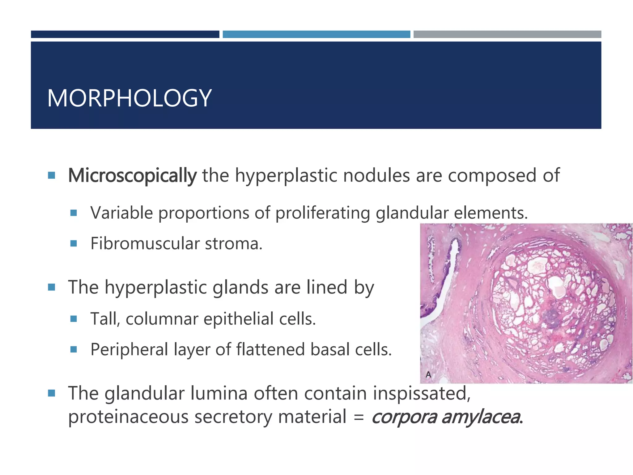 Benign prostatic hyperplasia | PPTX
