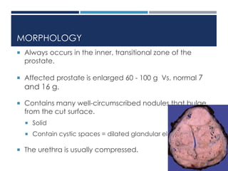 Benign prostatic hyperplasia | PPTX | Endocrine and Metabolic Diseases ...