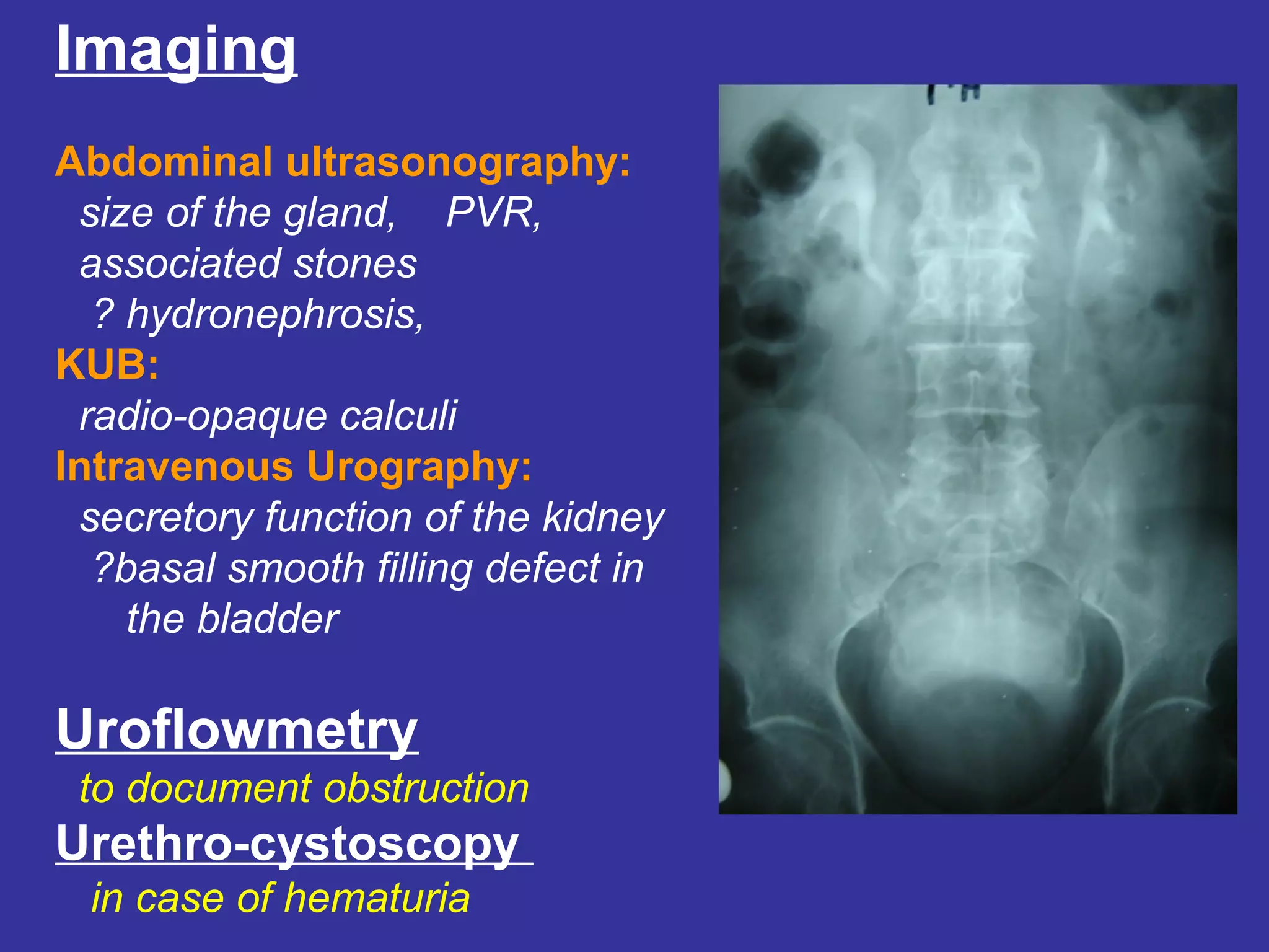 Benign prostatic hyperplasia | PPT