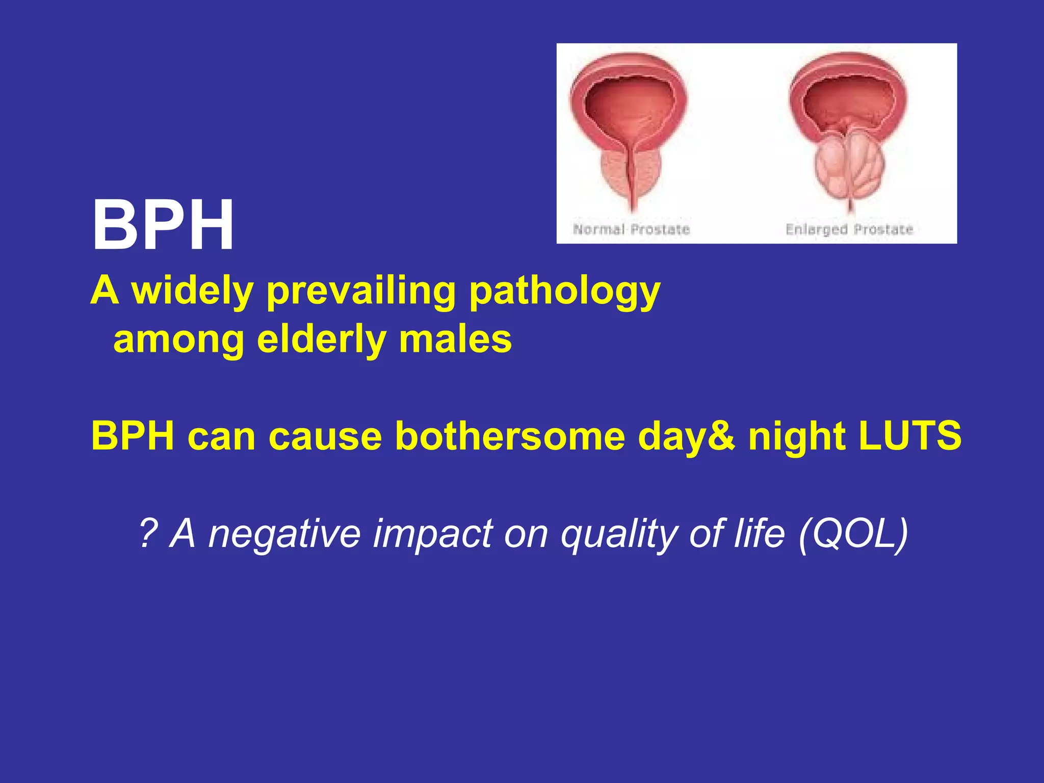 Benign prostatic hyperplasia | PPT