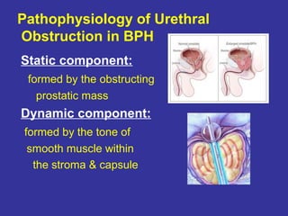 Benign prostatic hyperplasia | PPT