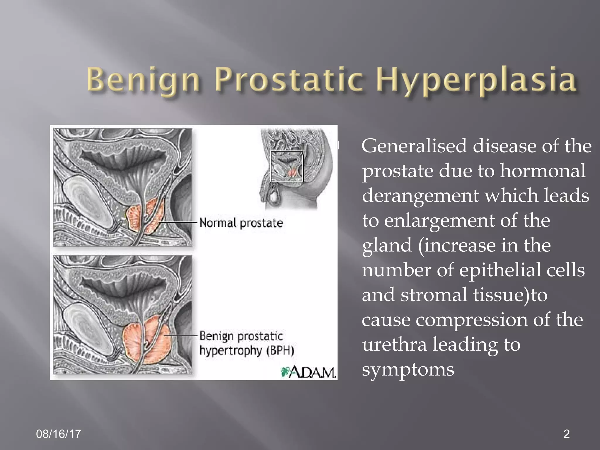 Benign prostatic hyperplasia | PPT