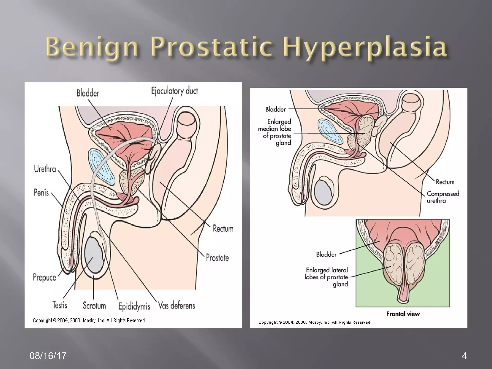 Benign prostatic hyperplasia | PPT