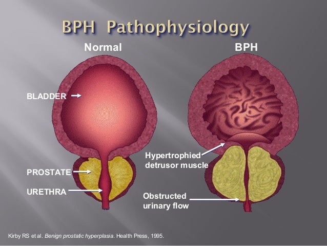 Benign prostatic hyperplasia