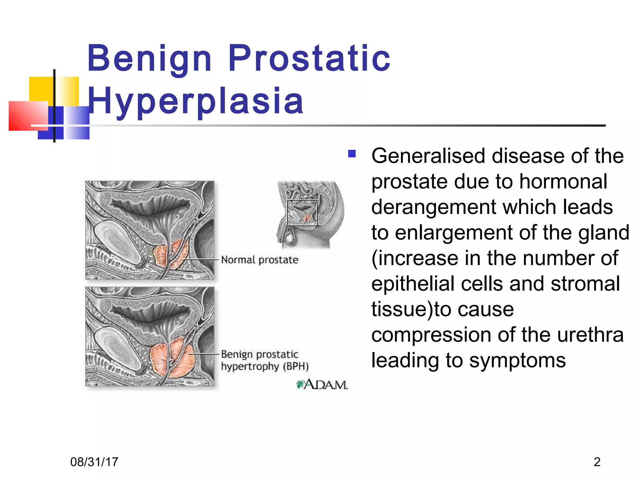 Benign prostatic hyperplasia | PPT