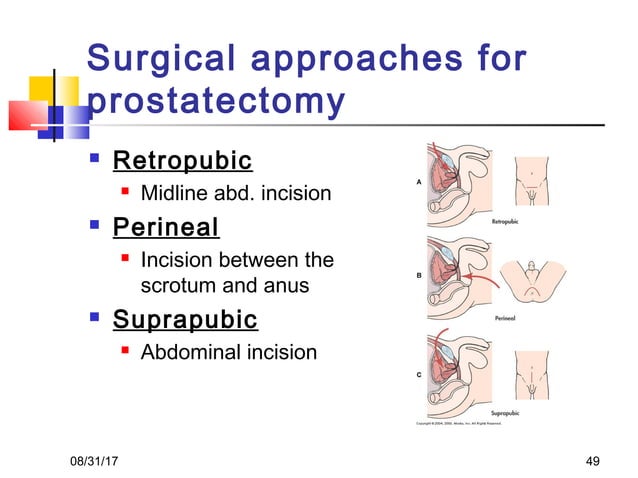 Benign prostatic hyperplasia | PPT | Sexual Conditions | Sexual Health