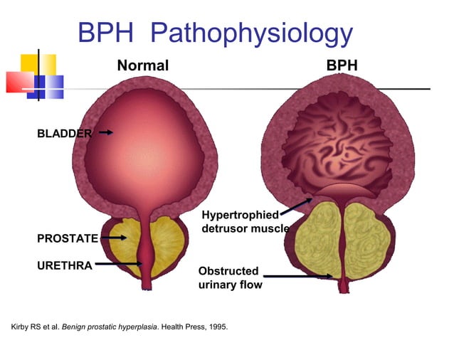 Benign prostatic hyperplasia | PPT | Sexual Conditions | Sexual Health