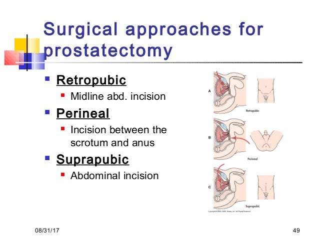 Benign prostatic hyperplasia